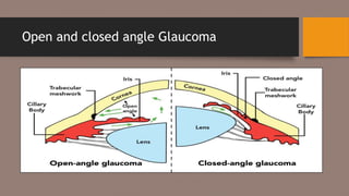 Glaucoma.pptx