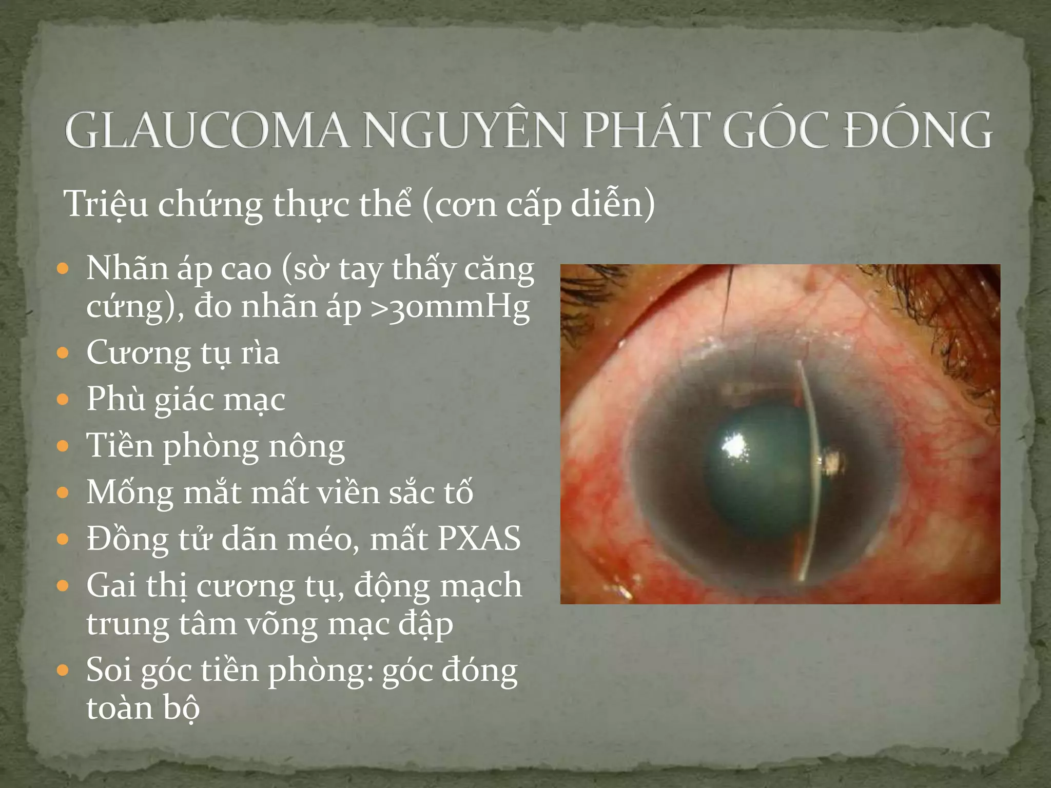 glaucoma.pdf