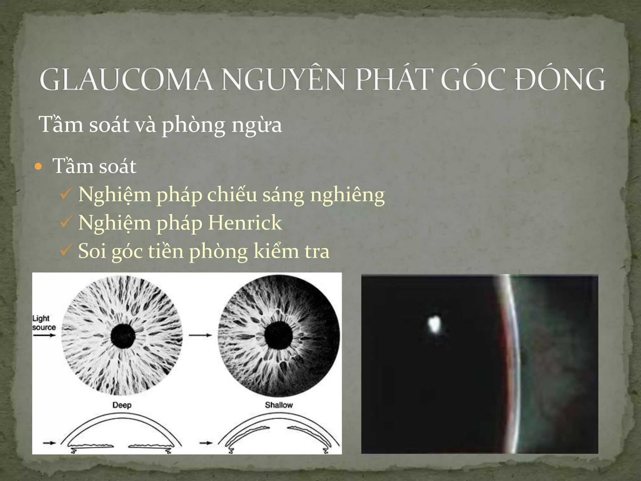 glaucoma.pdf