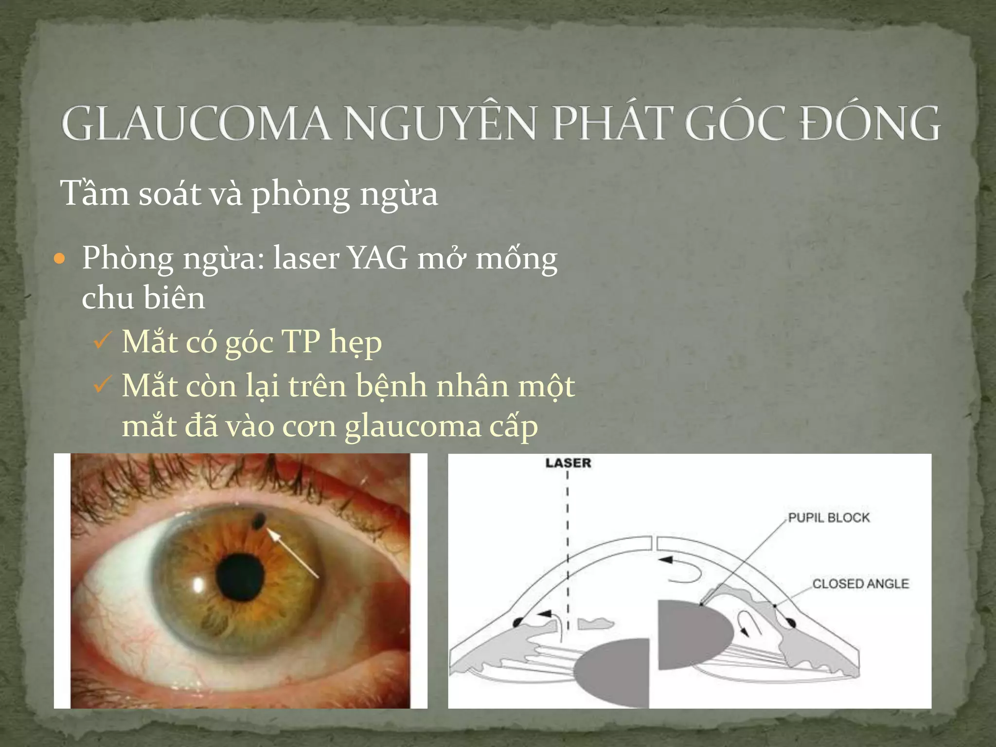 glaucoma.pdf