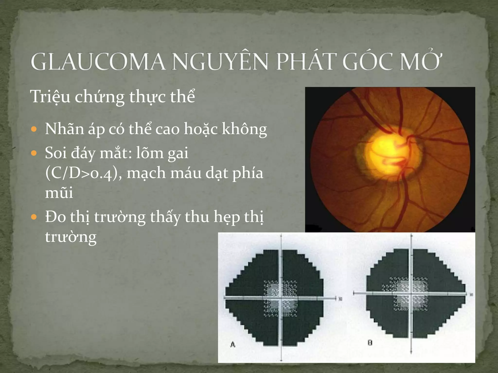 glaucoma.pdf