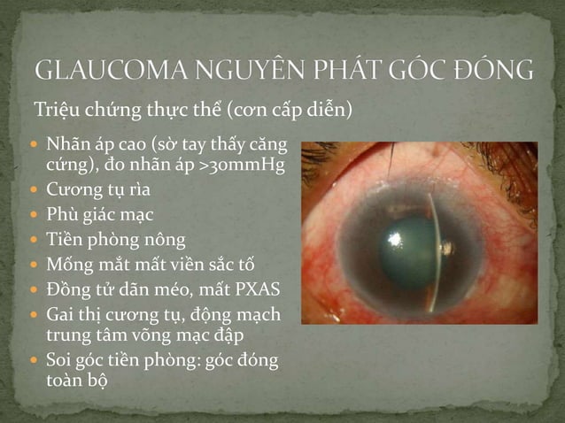 glaucoma.pdf