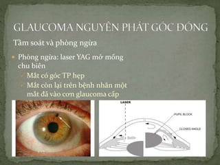 glaucoma.pdf