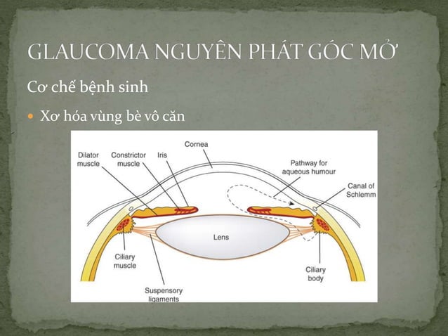 glaucoma.pdf