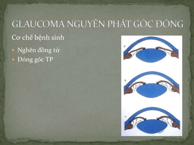 glaucoma.pdf