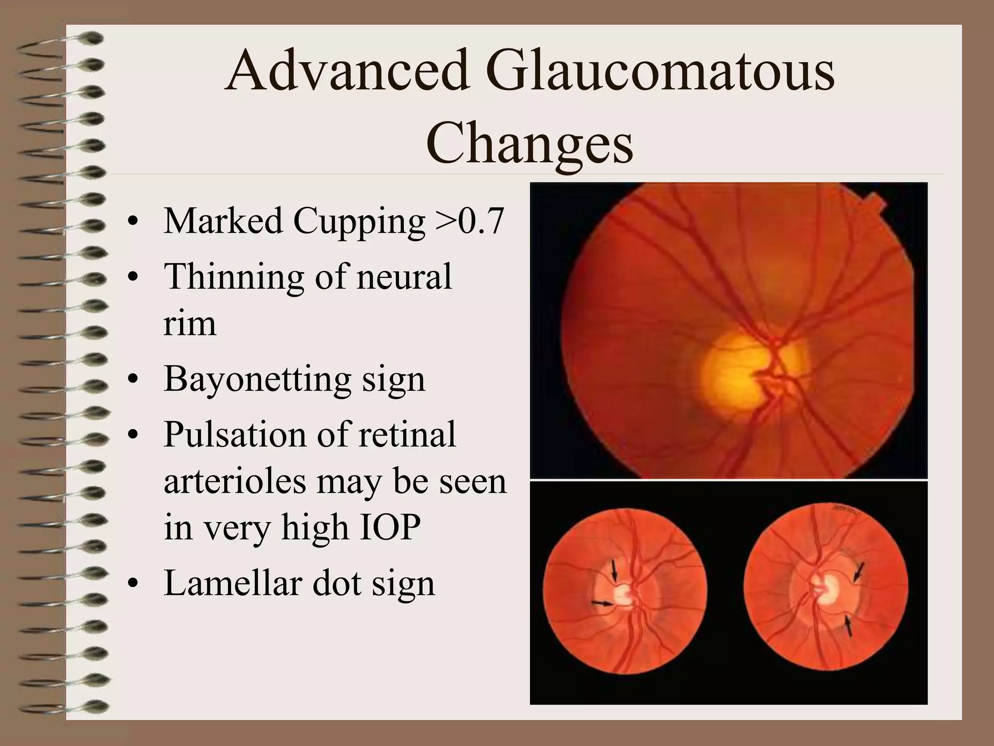 GLAUCOMA.ppt