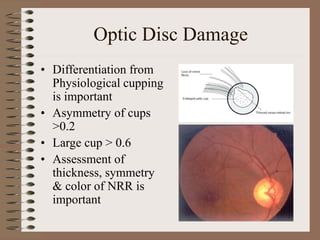 GLAUCOMA.ppt