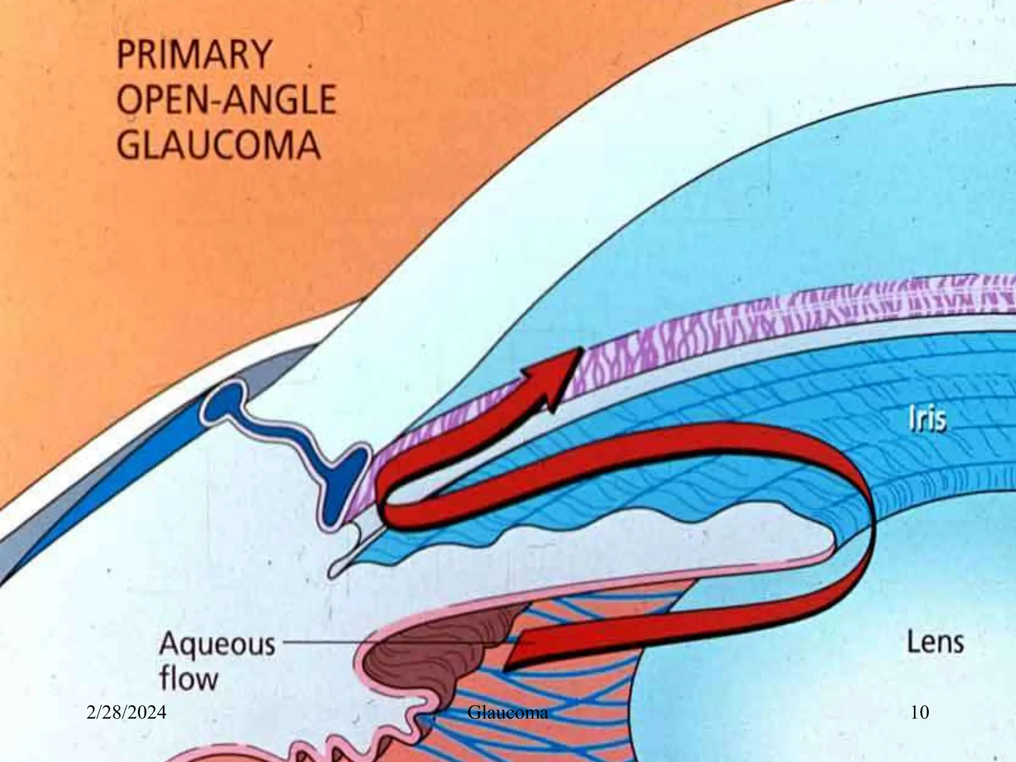 Glaucoma presentation short descriptions | PPTX | Eye and Vision ...