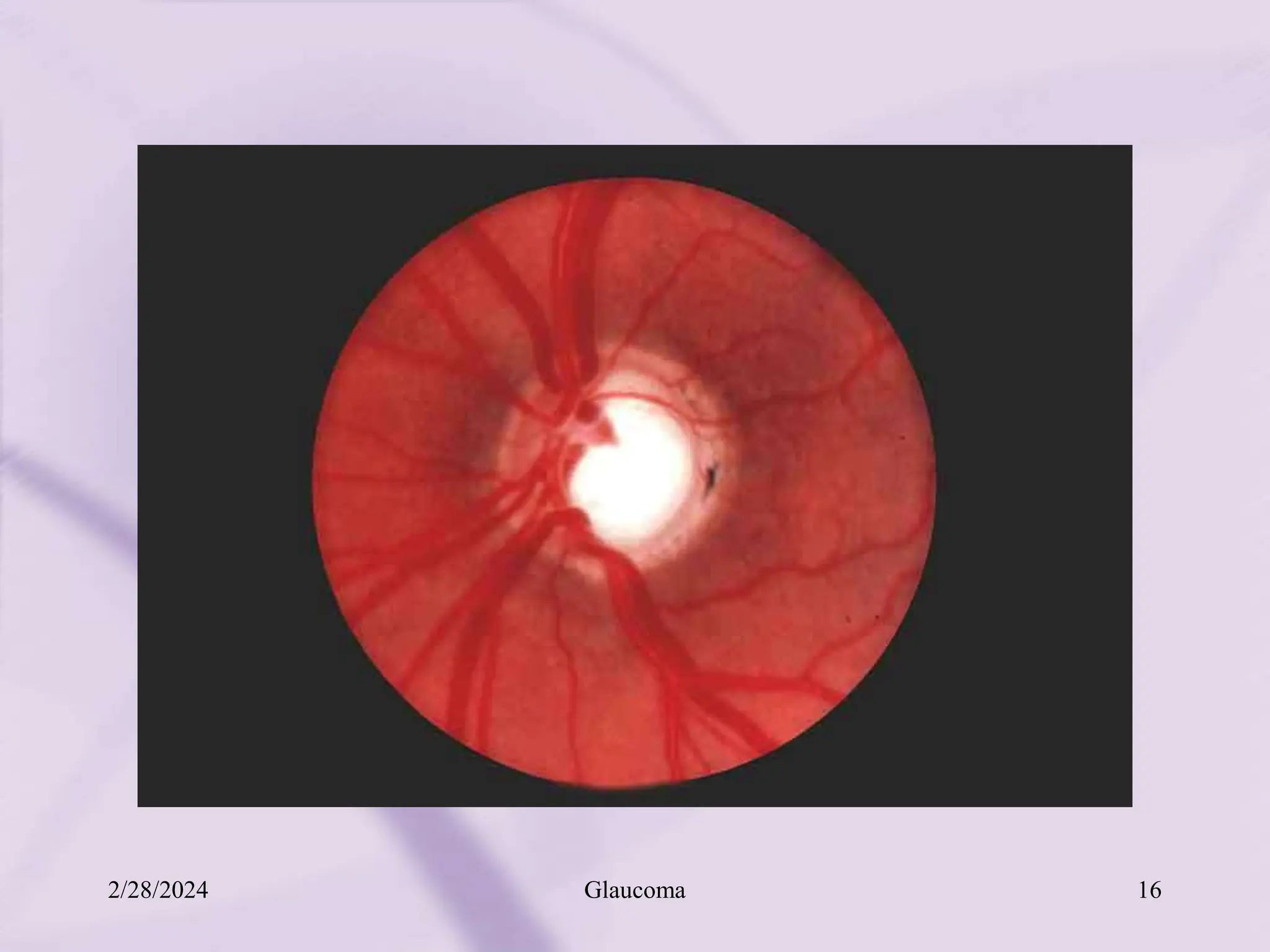Glaucoma presentation short descriptions | PPTX | Eye and Vision ...