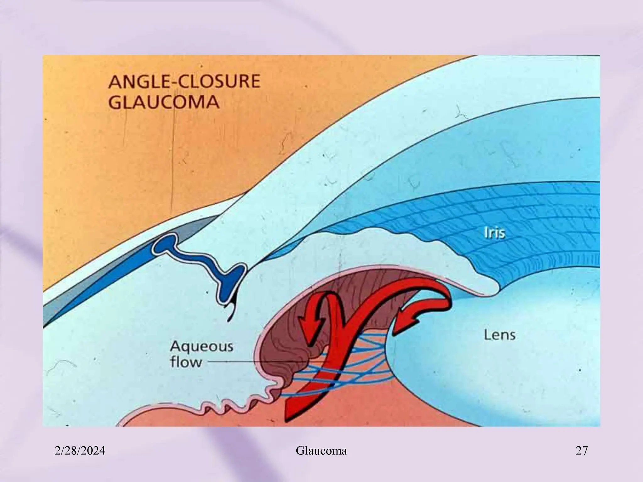 Glaucoma presentation short descriptions | PPTX | Eye and Vision ...