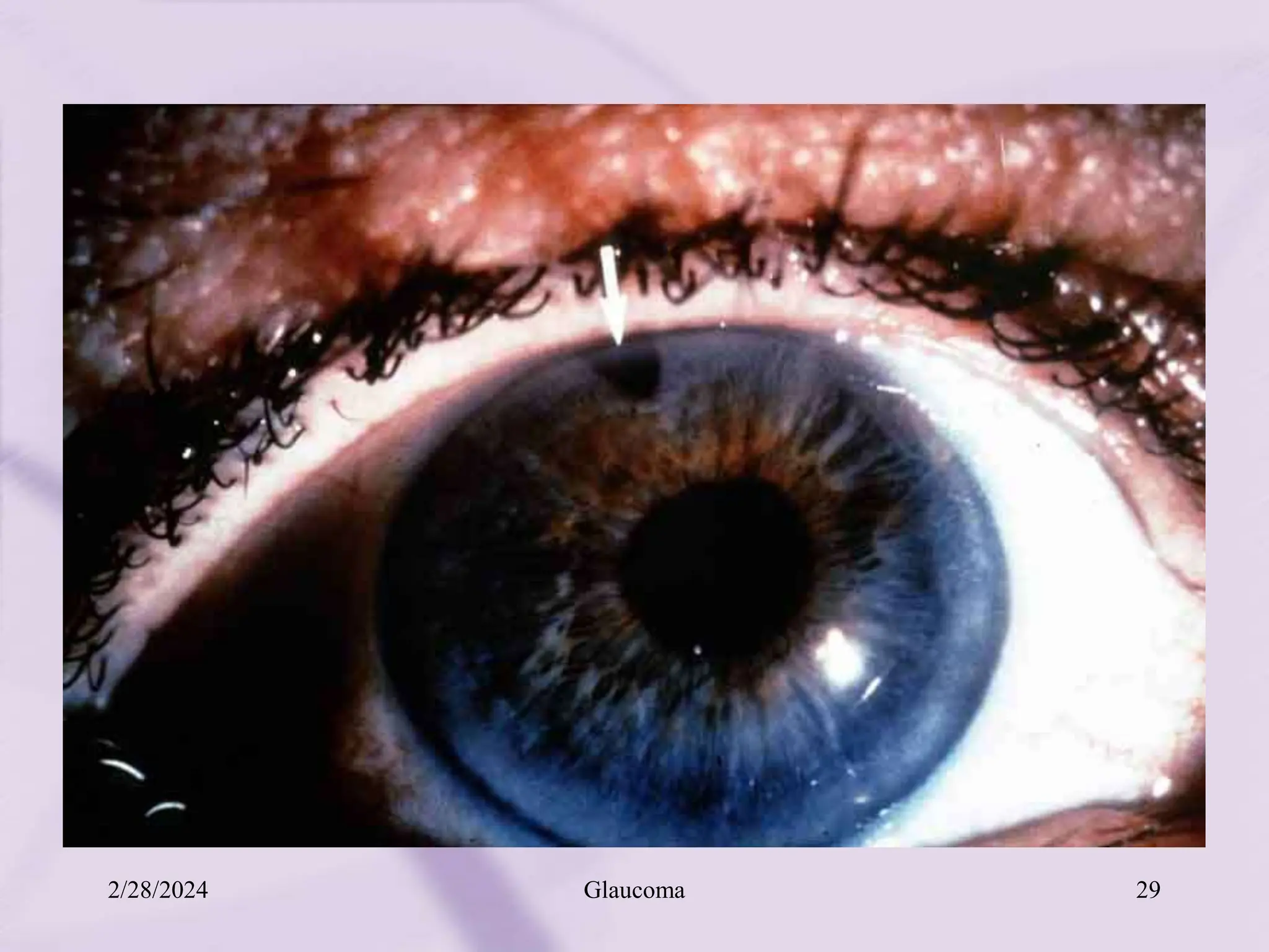 Glaucoma presentation short descriptions | PPTX | Eye and Vision ...