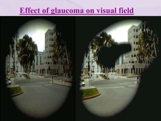 Glaucoma presentation short descriptions | PPTX