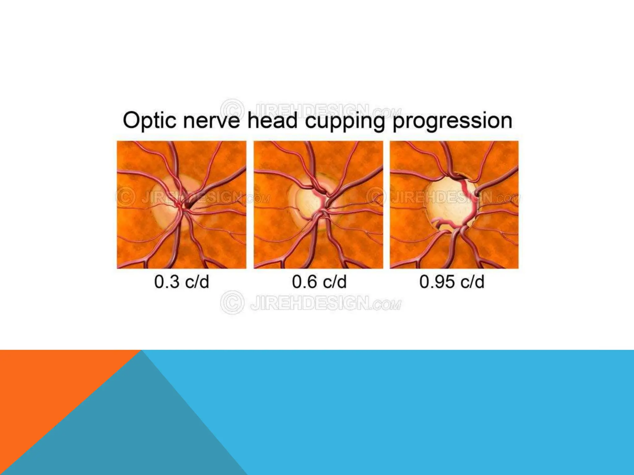 Glaucoma ophthalmology diagnosis ,signs,ttt | PPT