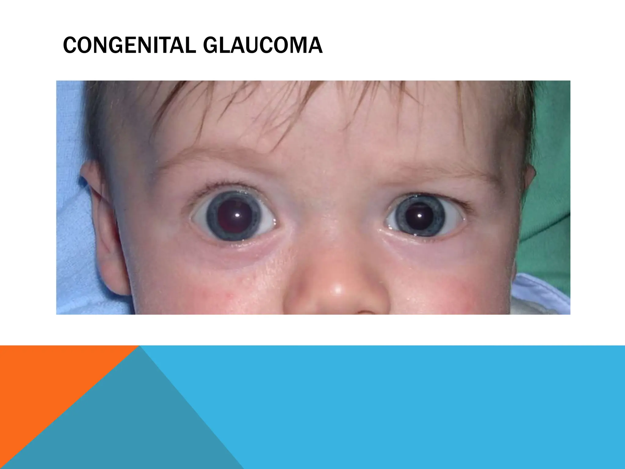 Glaucoma ophthalmology diagnosis ,signs,ttt | PPT