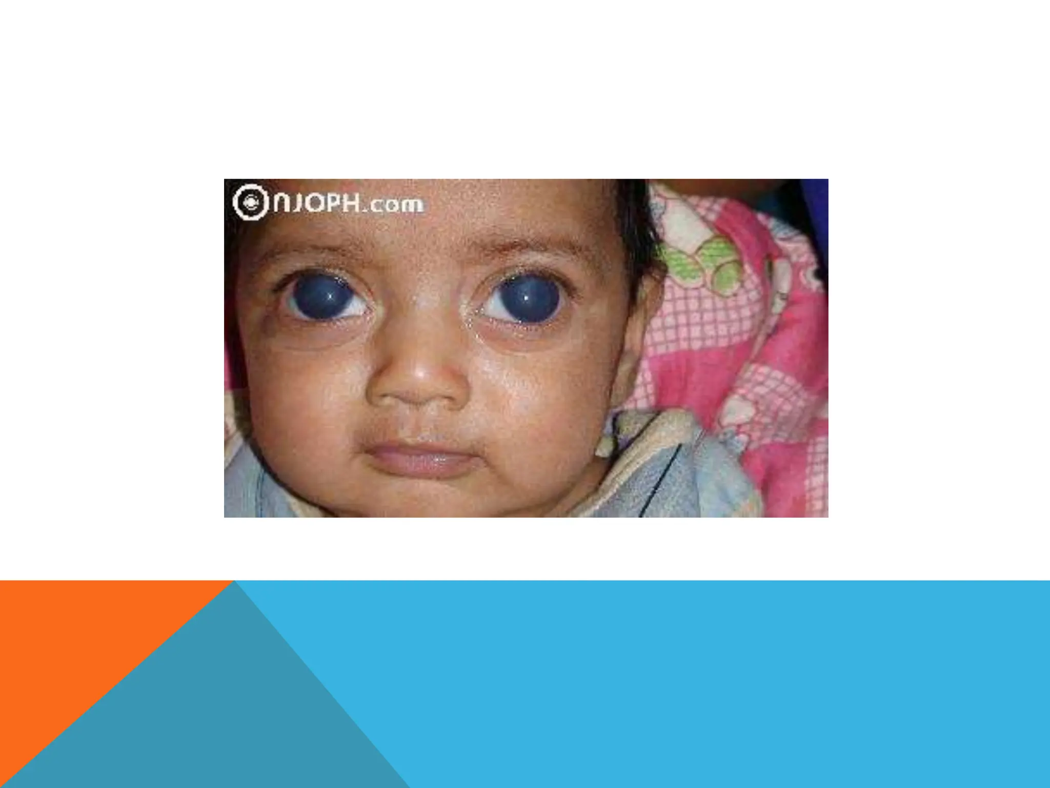 Glaucoma ophthalmology diagnosis ,signs,ttt | PPT