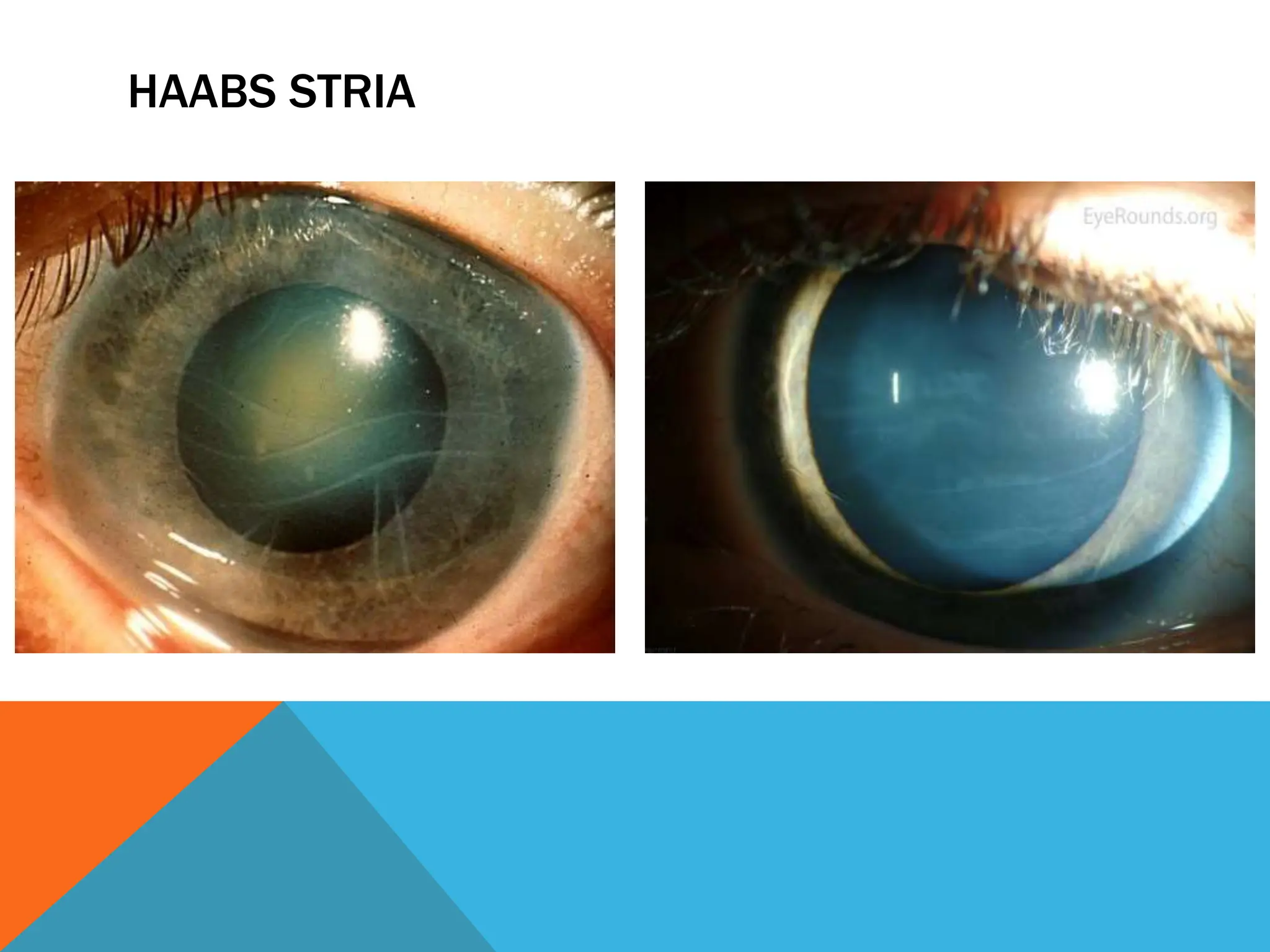 Glaucoma ophthalmology diagnosis ,signs,ttt | PPT
