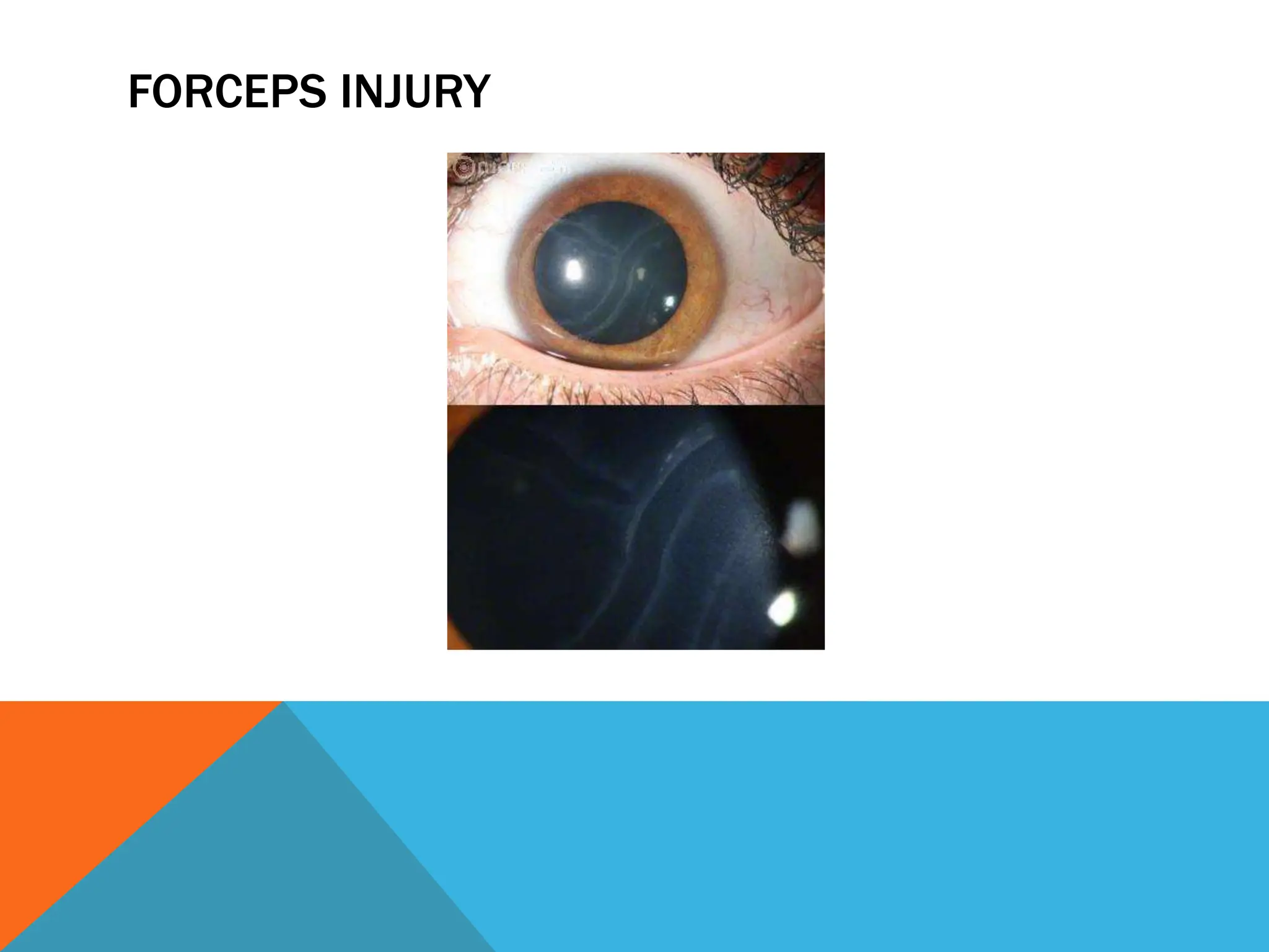 Glaucoma ophthalmology diagnosis ,signs,ttt | PPT