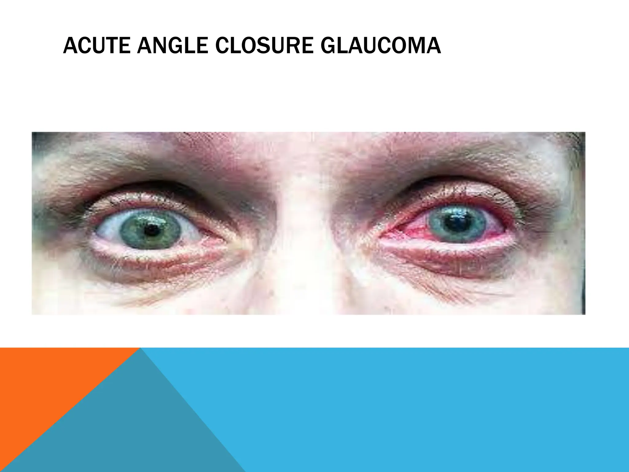 Glaucoma ophthalmology diagnosis ,signs,ttt | PPT