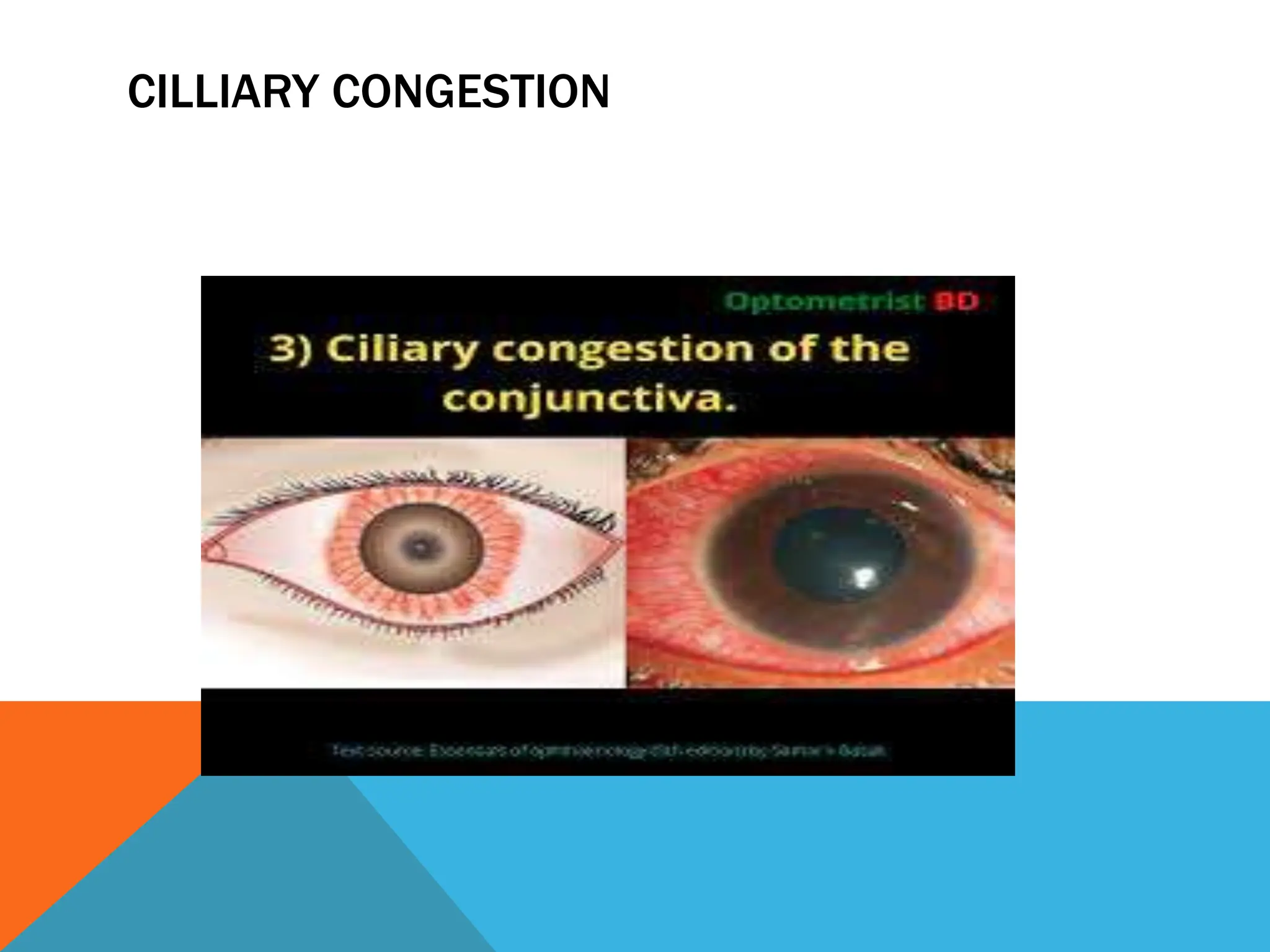 Glaucoma ophthalmology diagnosis ,signs,ttt | PPT