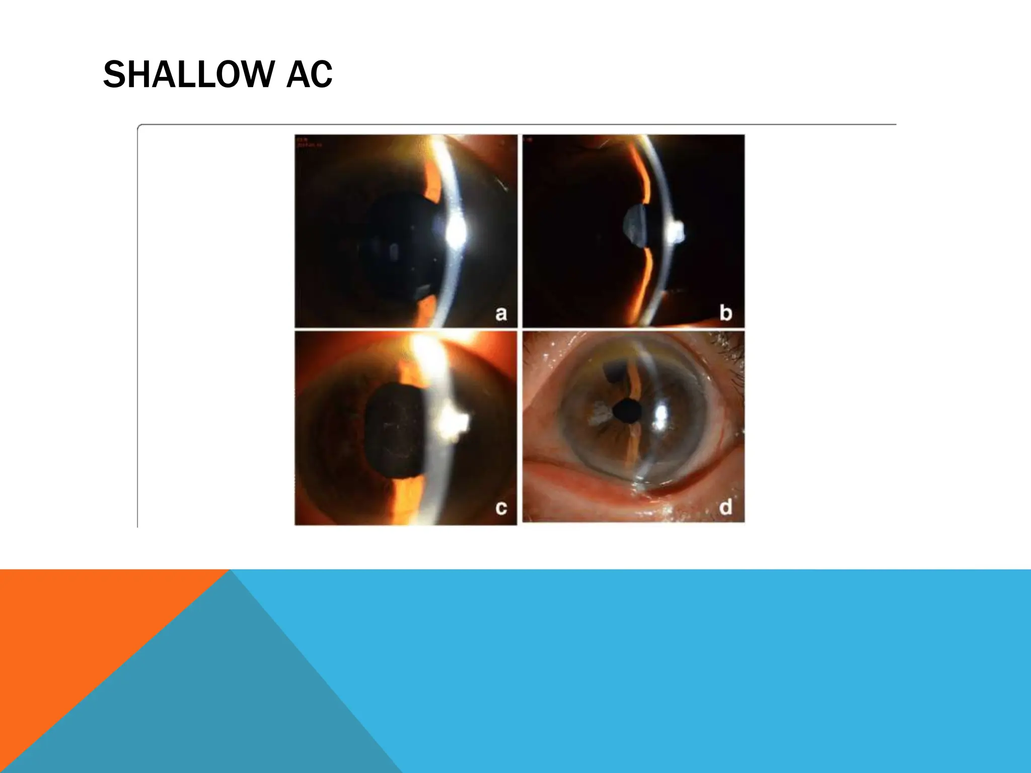Glaucoma ophthalmology diagnosis ,signs,ttt | PPT