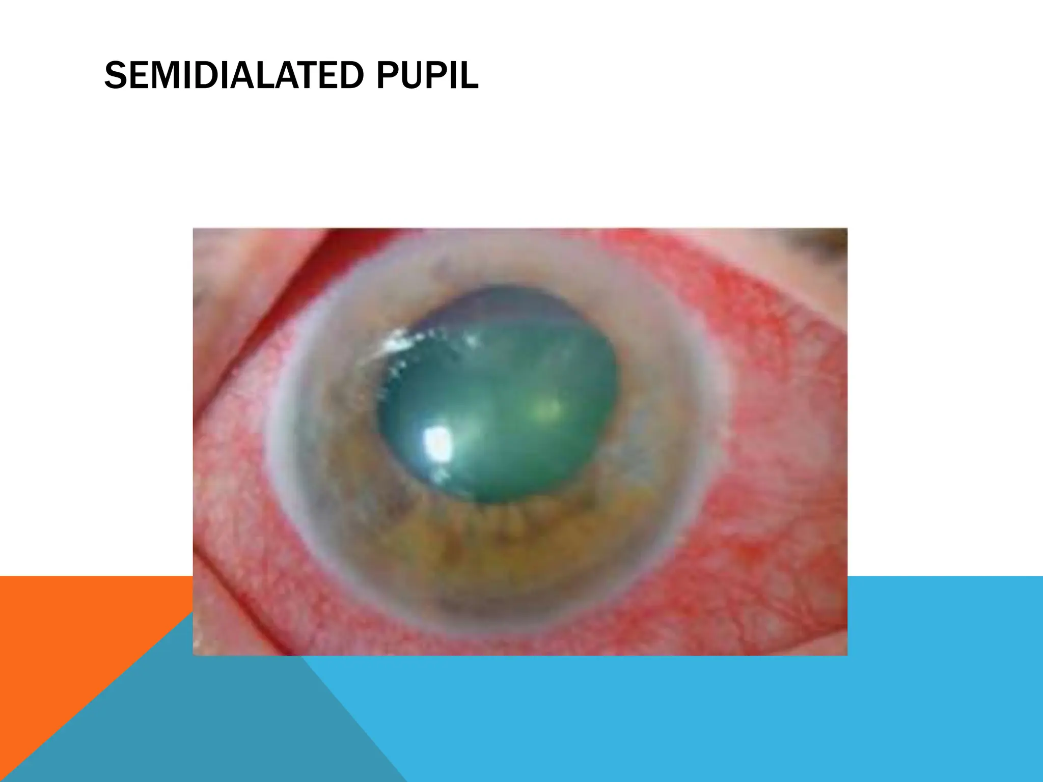 Glaucoma ophthalmology diagnosis ,signs,ttt | PPT