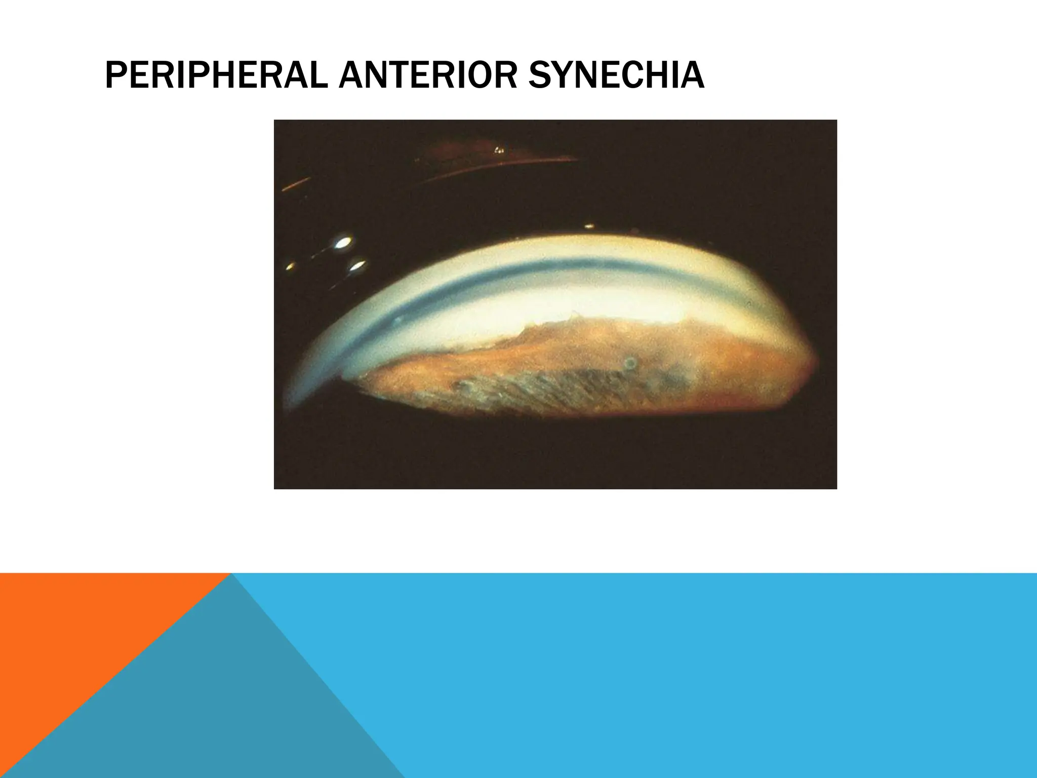 Glaucoma ophthalmology diagnosis ,signs,ttt | PPT