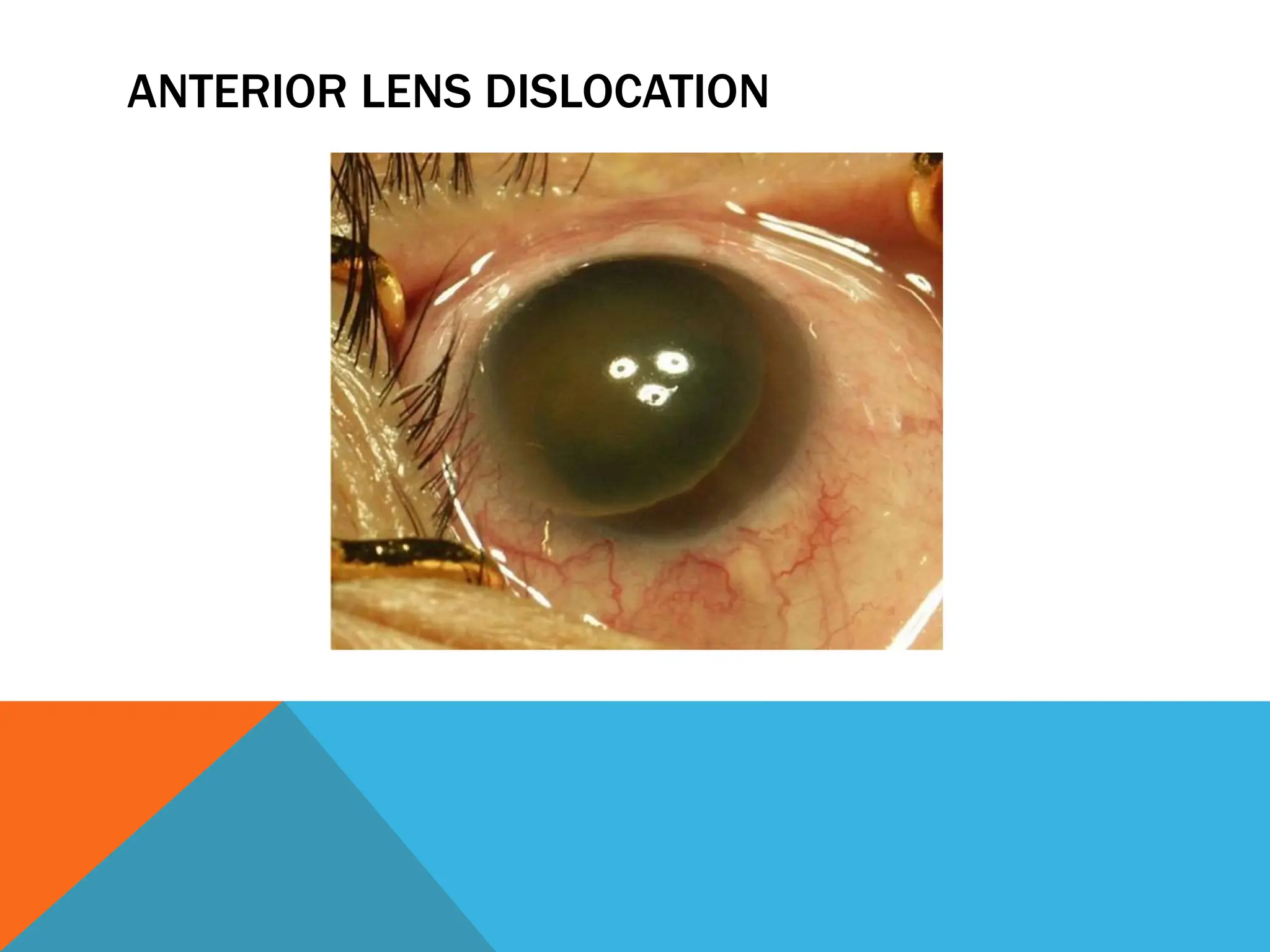 Glaucoma ophthalmology diagnosis ,signs,ttt | PPT
