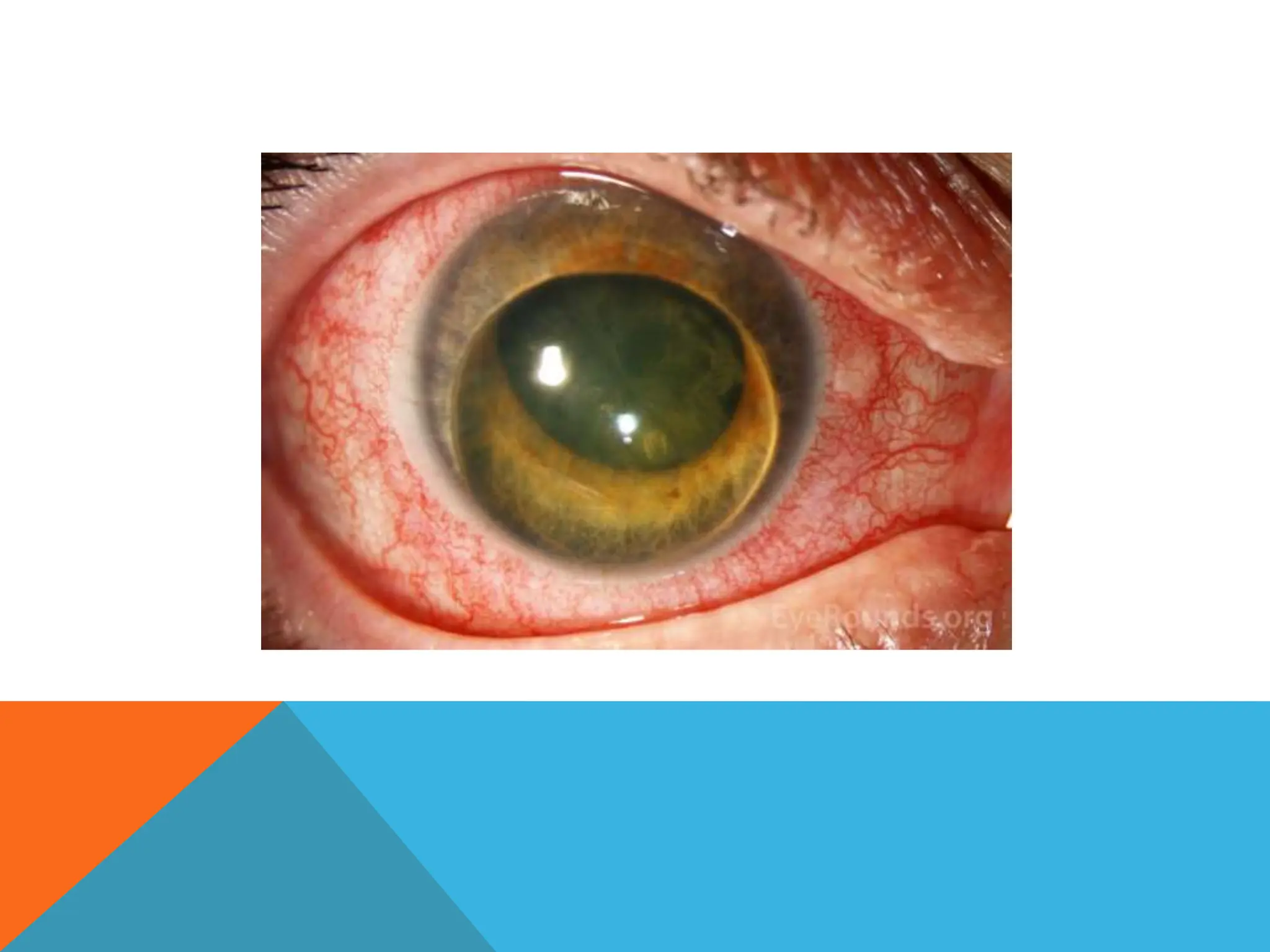 Glaucoma ophthalmology diagnosis ,signs,ttt | PPT