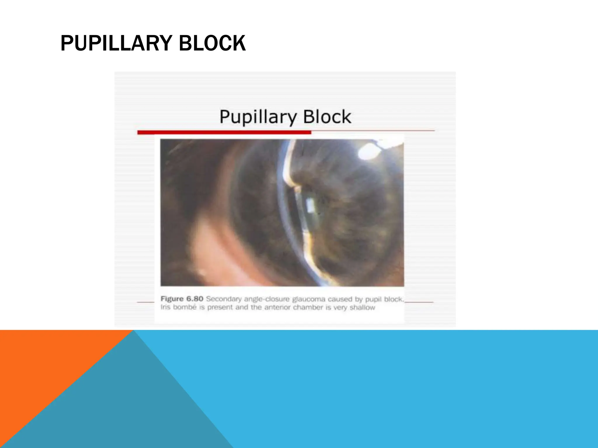 Glaucoma ophthalmology diagnosis ,signs,ttt | PPT