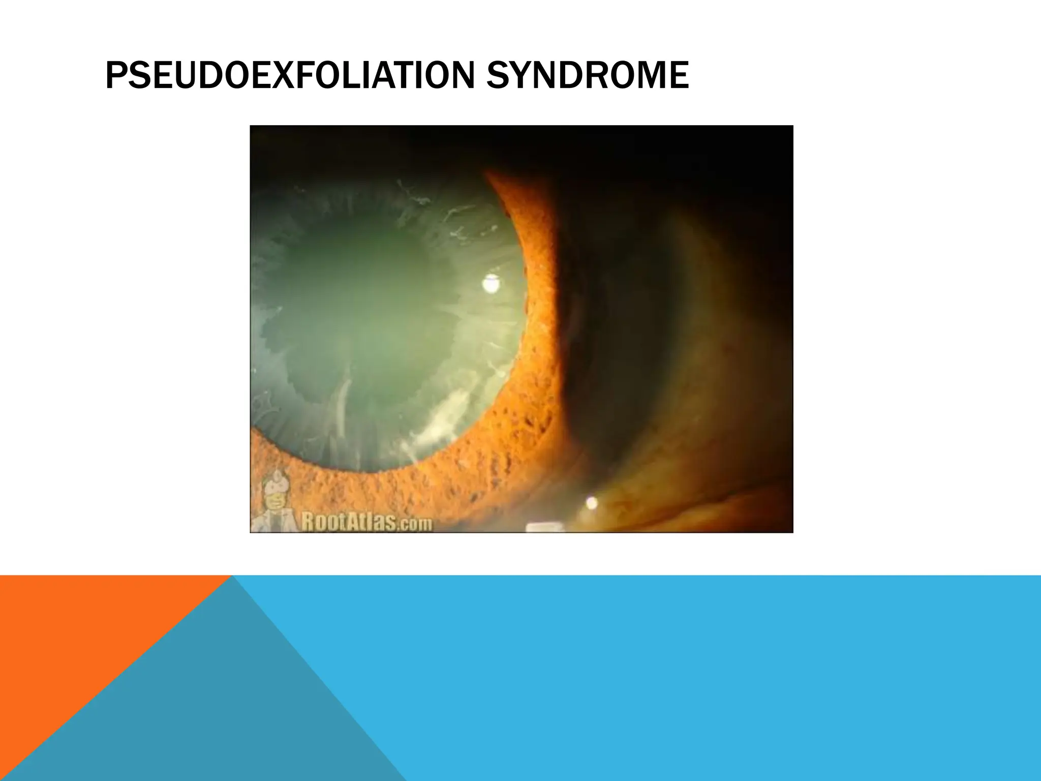Glaucoma ophthalmology diagnosis ,signs,ttt | PPT