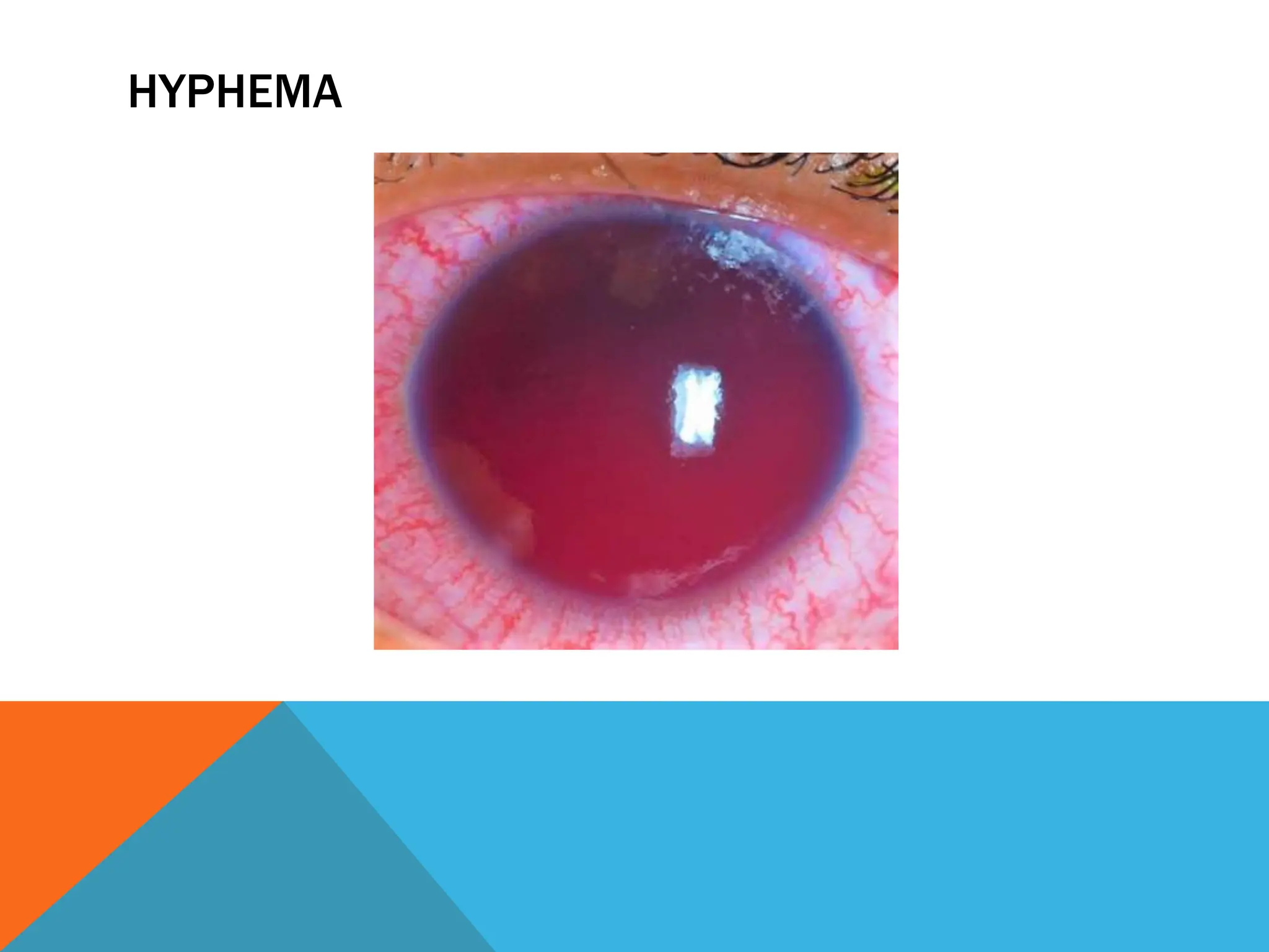 Glaucoma ophthalmology diagnosis ,signs,ttt | PPT