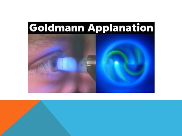 Glaucoma ophthalmology diagnosis ,signs,ttt | PPT