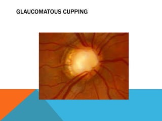 Glaucoma ophthalmology diagnosis ,signs,ttt | PPT