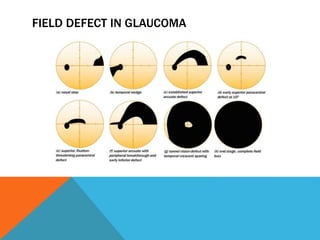 Glaucoma ophthalmology diagnosis ,signs,ttt | PPT