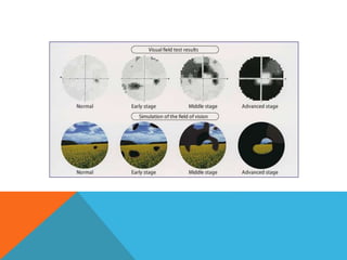 Glaucoma ophthalmology diagnosis ,signs,ttt | PPT