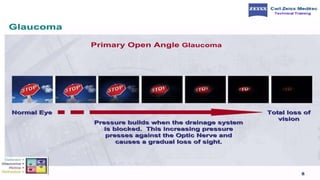 GLAUCOMA of human eye for certificate nurses | PPTX