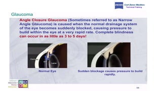 GLAUCOMA of human eye for certificate nurses | PPTX