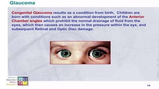 GLAUCOMA of human eye for certificate nurses | PPTX