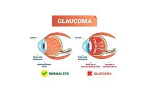 GLAUCOMA of human eye for certificate nurses | PPTX