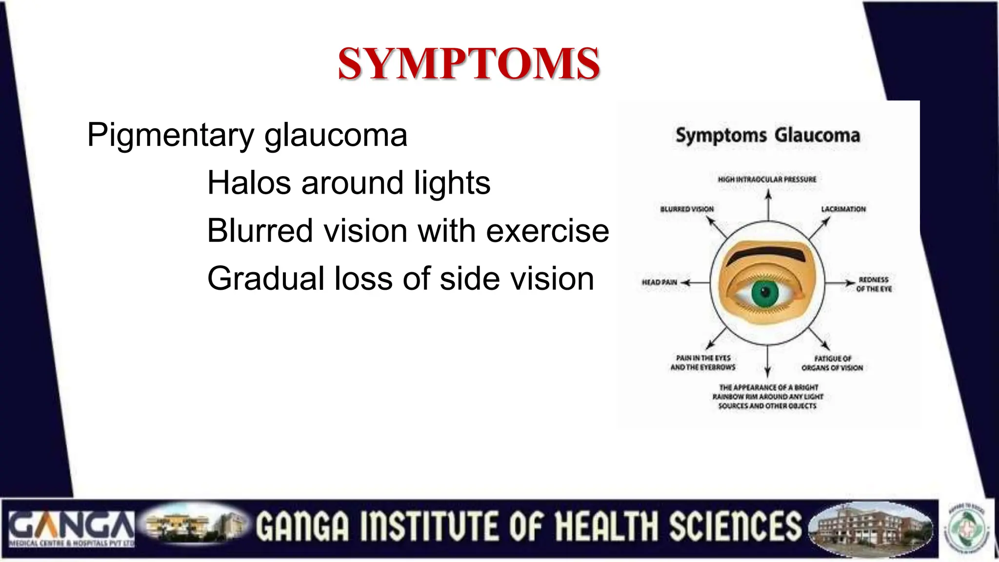 glaucoma and its management.pptx for nursing students | PPTX