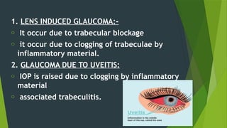 GLAUCOMA -disease ,symptoms, sign, types ,management.pptx
