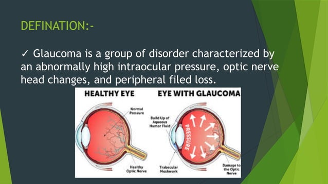 GLAUCOMA -disease ,symptoms, sign, types ,management.pptx