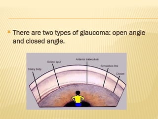 Glaucoma classroom lecture for students. ppt | PPTX