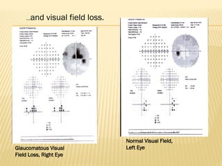 Glaucoma classroom lecture for students. ppt | PPTX