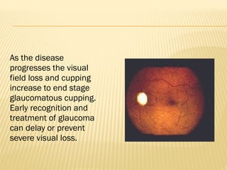 Glaucoma classroom lecture for students. ppt | PPTX