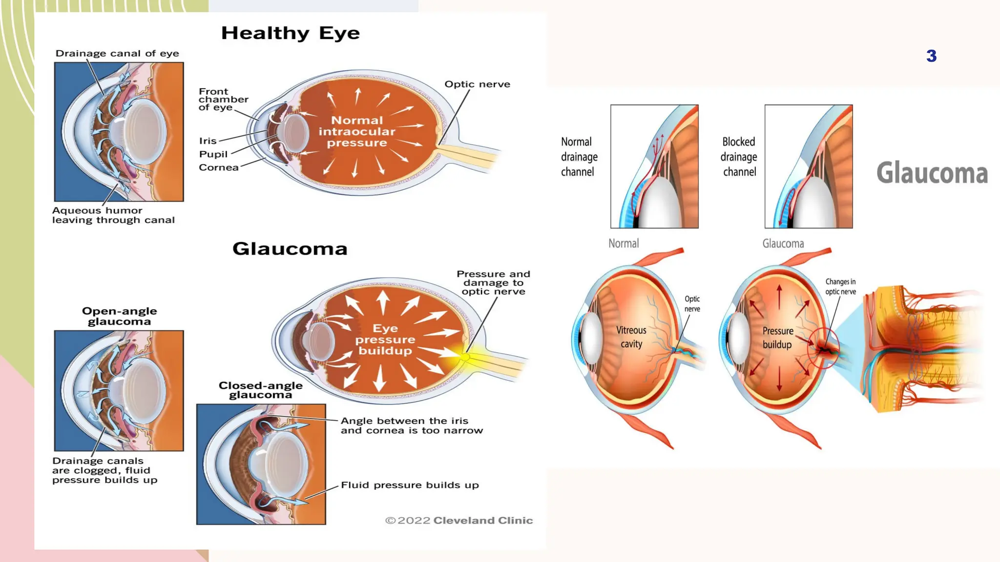 GLAUCOMA and its classification ppt | PPTX