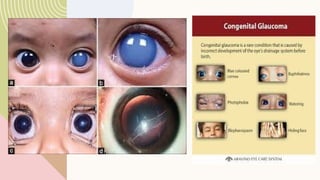 GLAUCOMA and its classification ppt | PPT