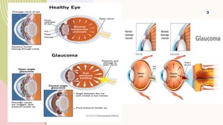 GLAUCOMA and its classification ppt | PPT