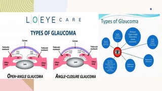 GLAUCOMA and its classification ppt | PPT
