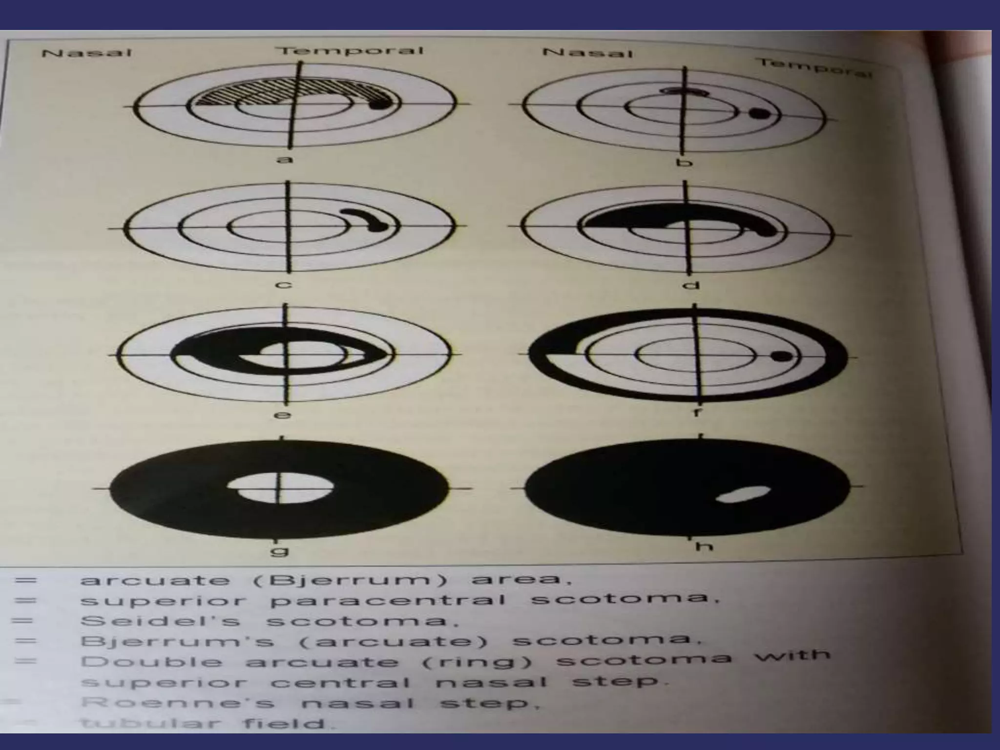 Glaucoma POAG | PPT | Eye and Vision Conditions | Diseases and Conditions